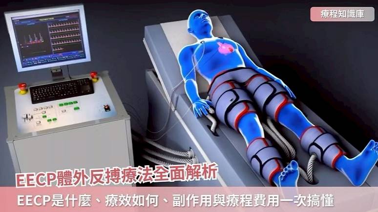 EECP全面解析：體外反搏療法是什麼、療效如何、副作用與療程費用一次搞懂 | 有醫靠 | LINE TODAY