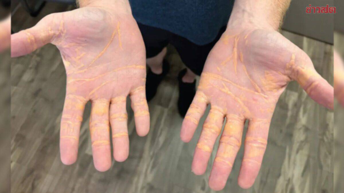 ชายวัย 40 เน้นกินแต่ชีส-นม ตรวจเจอ คลอเรสเตอรอลพุ่ง ก้อนสีเหลืองผุดตามผิว | Khaosod | LINE TODAY