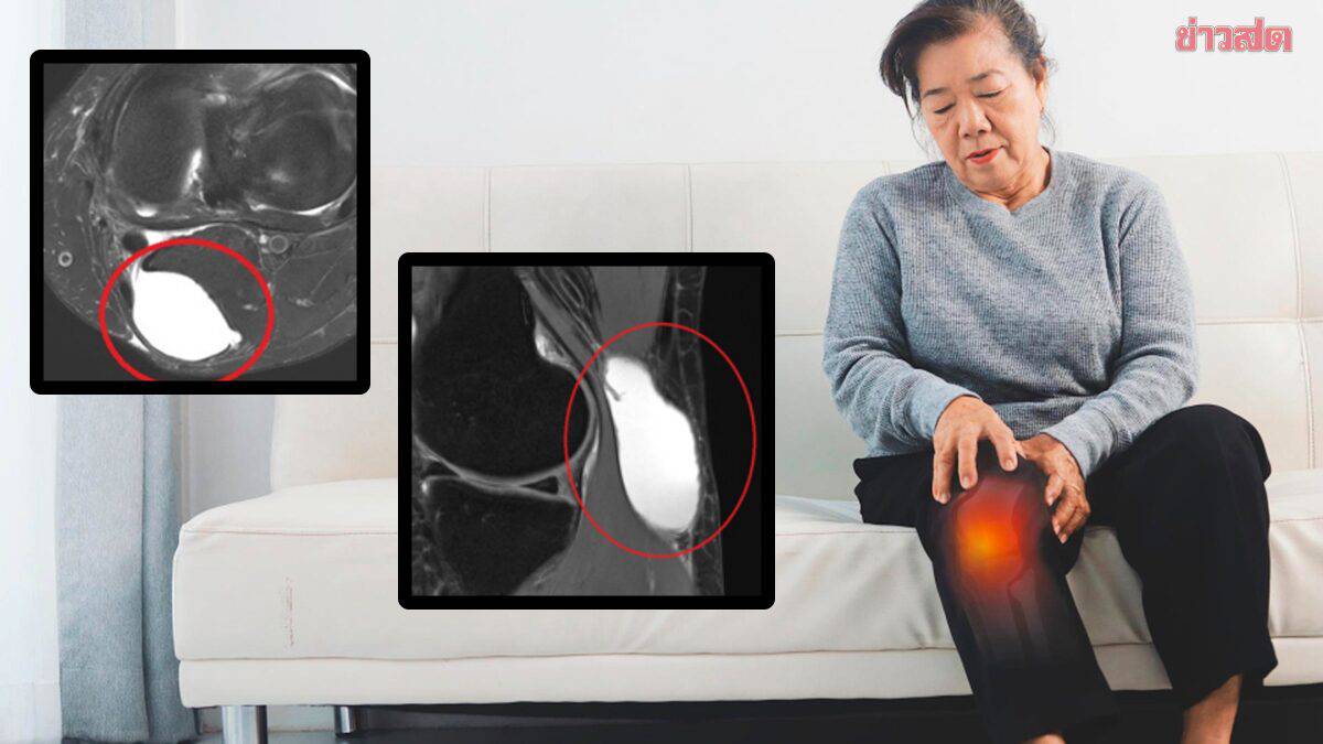 หญิงมีอาการชา ขึ้น-ลงบันไดติดขัด พบภาวะถุงน้ำเบเกอร์ จนเห็นก้อนหลังเข่า ...