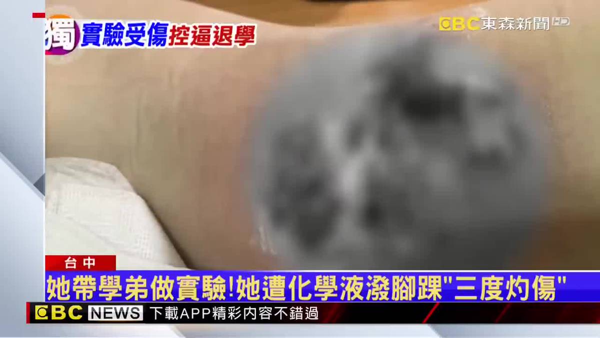 獨／她帶學弟做實驗！ 化學液潑腳踝「三度灼傷」 | EBC 東森新聞影音 | LINE TODAY