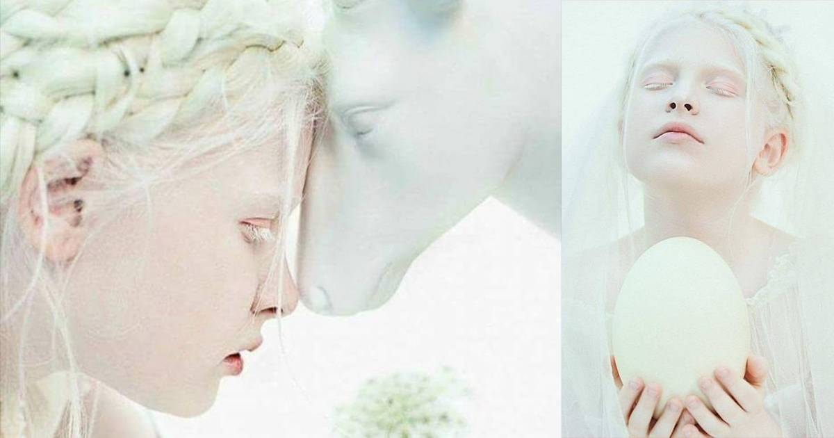 ส่อง! 25 ภาพงดงามดั่งเจ้าหญิง ของผู้หญิงของที่มีภาวะ “ผิวเผือก” | AKERU | LINE TODAY