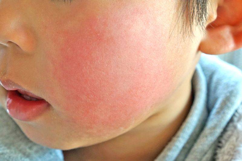 11歲女童「叫一聲」離奇猝逝！疑染B19「蘋果病」 醫示警3類人風險高 | 鏡週刊 | LINE TODAY